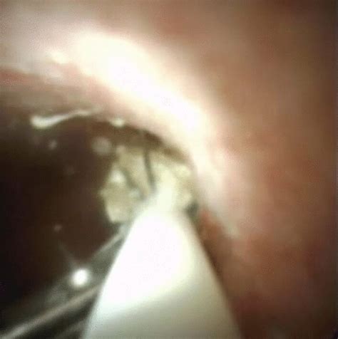 Cholangioscopy Guided Clip Retrieval From The Common Bile Duct