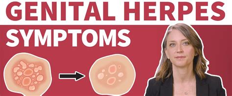 Understanding Herpes Symptoms What You Need To Know