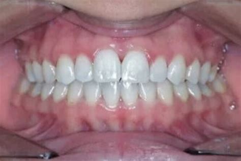 Braces Case 1 The Edge Dental Dentist In Alderley Edge Cheshire