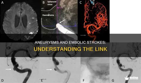 Aneurysms And Embolic Strokes Understanding The Link Medshun
