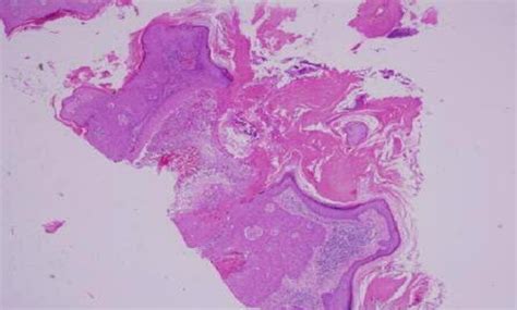 Cup Shaped Invagination Of Squamous Epithelium Surrounding A Central