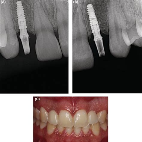 Occlusal View Of Implants Final Position Download Scientific Diagram