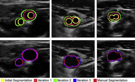 Segmentation Results Using The Described Method On Ultrasound For Download Scientific Diagram
