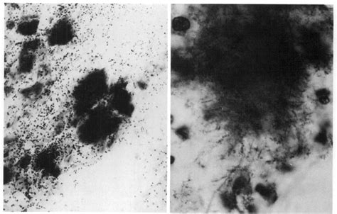 Right Higher Magnification Of An Actinomyces Clump In A