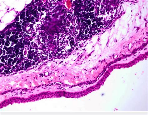 Thymic Cyst Pathology Outlines At Lucinda Kindler Blog
