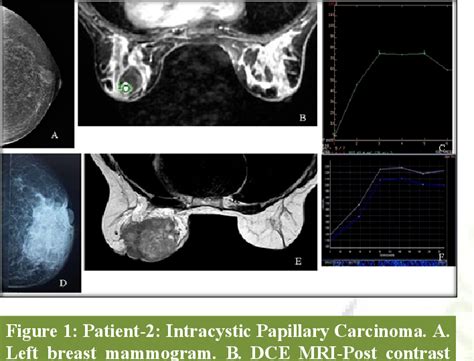 Figure 1 From Role Of Dynamic Contrast Enhanced Magnetic Resonance Imaging And Mammogram In