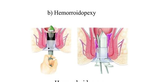 Hemorrhoid Treatment 10 Types Of Hemorrhoid Medical Treatment Pptx