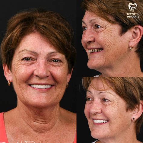 Dental Implants Newcastle Teeth On Implants
