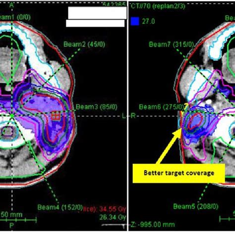 The Left Image Shows The Isodose Areas Dark Blue Surface Obtained Download Scientific