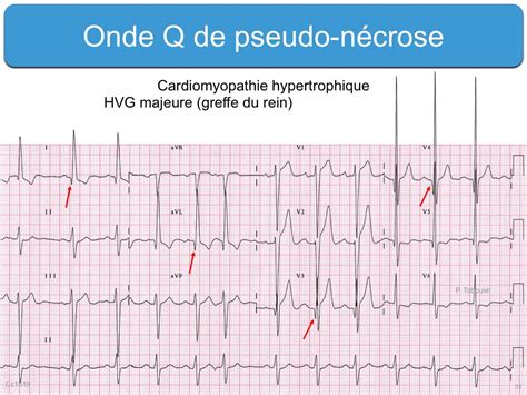 Onde Q De Pseudo Nécrose E Cardiogram