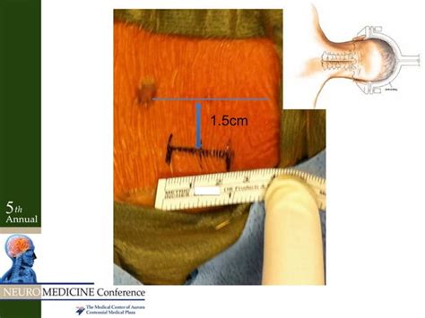 Radiculopathy Vs Peripheral Neuropathy Ppt