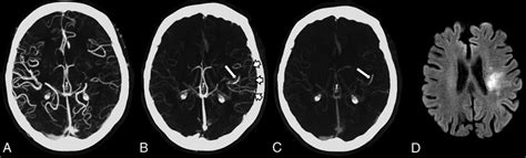 Multiphase Cta And Follow Up Mr Imaging Of An 83 Year Old Woman Download Scientific Diagram