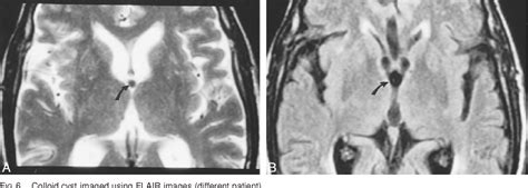 Figure 1 From Imaging Pathologic Correlation Colloid Cyst Of The Third