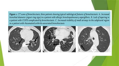 Bronchiectasis Etiologypathophysiologymanagement Ppt