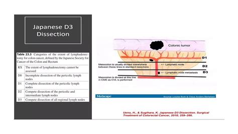 Complete Mesocolic Excision Cme Vs D2pptx
