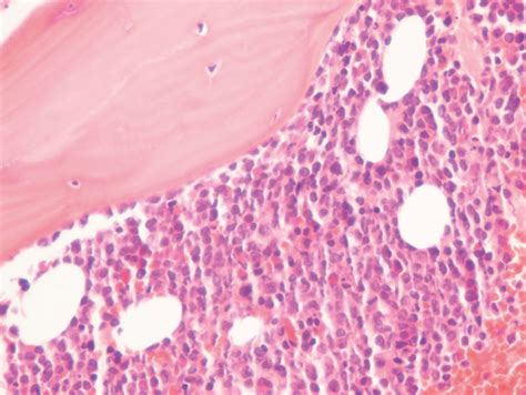 Acute Myeloid Leukemia Oncohema Key