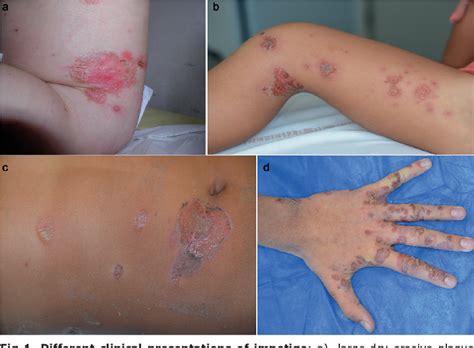 Figure 1 From Skin Infections Caused By Staphylococcus Aureus Semantic Scholar