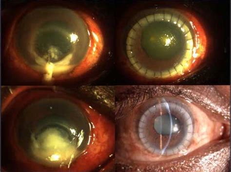 Clinical Challenges Corneal Infections Darshan Eye Care