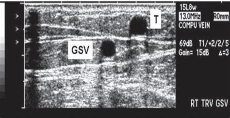 Chapter 20 Venous Valvular Insufficiency Testing Flashcards Quizlet