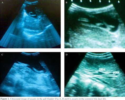 Figure 3 From Gallbladder Ascariasis Semantic Scholar