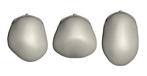 Brachycephaly In Adults