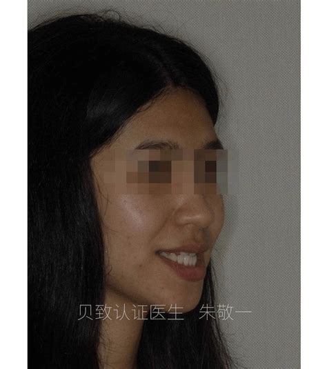 地包天女孩潜力无穷手术级反案例分享 贝致案例库 贝致专业口腔服务平台权威医生真实案例一次看够