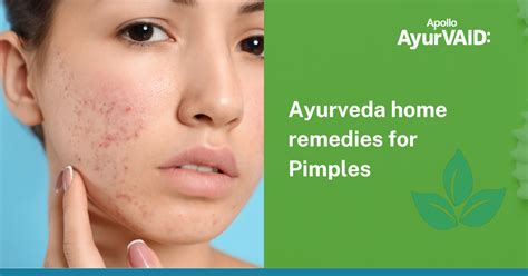 Ayurvedic Home Remedies For Pimples Pimples Treatment In Ayurveda