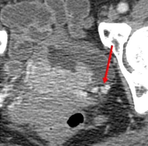 Contrast Enhanced Ct Scan Showing A Large Lobulated Bladder
