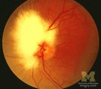 Myelinated Nerve Fibers Ophthalmoscopic Abnormalities The Eyes Have