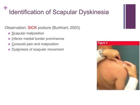 Scapular Dyskinesia And Its Relationship To Rotator Cuff Impingement