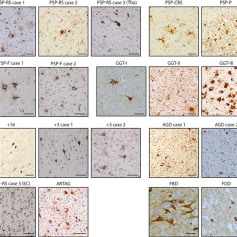 Pdf Structure Based Classification Of Tauopathies