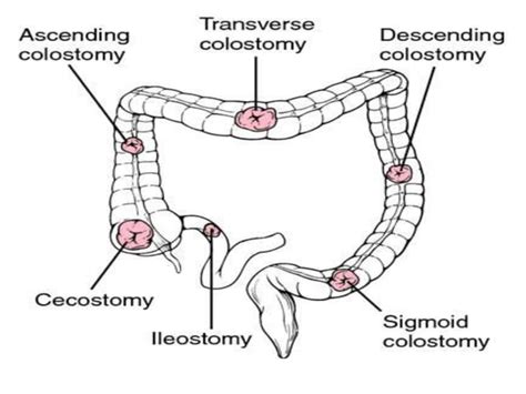 Colostomy Ppt