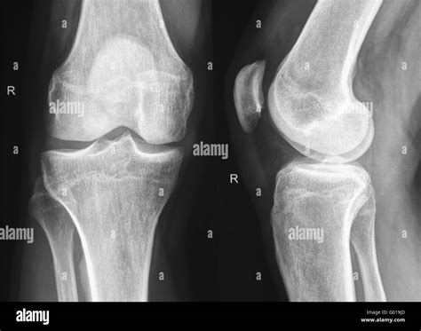 Xknee Startradiology Radiologa Fracturas Rodillas