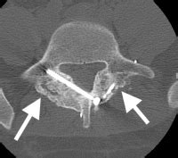 Surgical Repair Of Pars Interarticularis Fractures Spine Surgeon