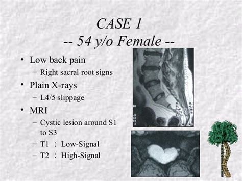 Surgical Treatment Of Symptomatic Sacral Cysts