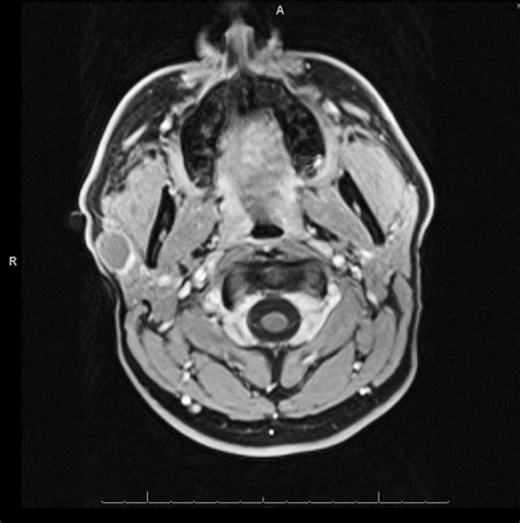 Mri Shows Right Cystic Parotid Lesion 2 × 2 × 16 Cm With Subtle Wall