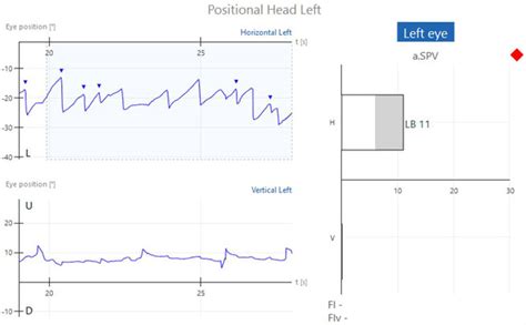 Visualeyes™ Positional Nystagmus Testing Interacoustics