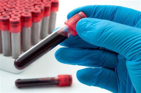 Light Blue Tube Phlebotomy Market Size And Forecast To 2028