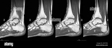 Normal Ankle Magnetic Resonance Imaging Mri Scans Of A Womans
