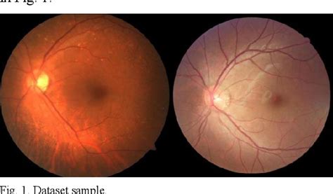 Figure 1 From Glaucoma Diagnosis And Prediction Based On Multi Scale