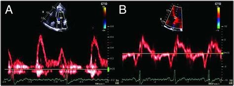 A The Mitral Inflow Pattern Shows A Deceleration Time Of Ms B Download Scientific