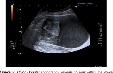 Figure 2 From Primary Retroperitoneal Mucinous Cystadenoma With A