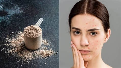 Whey Protein Side Effects On Skin Can It Cause Acne Healthshots