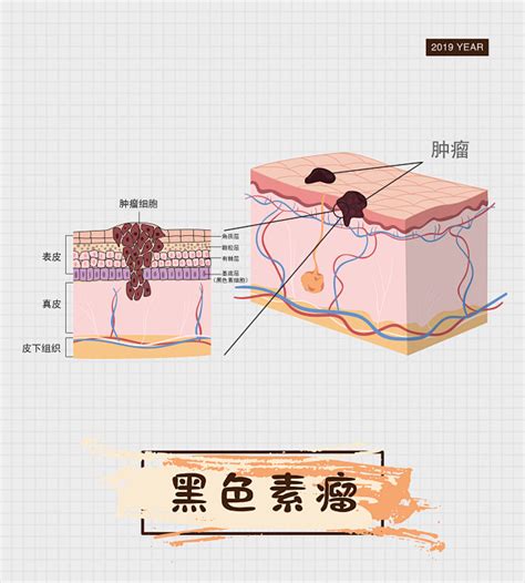 黑色素瘤 肿瘤癌症细胞疾病症状医疗人体系统 人体解剖 人体器官内脏 医疗图 人体结构 人体医学研究 人体部位 医疗保健医疗护理 医疗插画 卡通手绘漫画