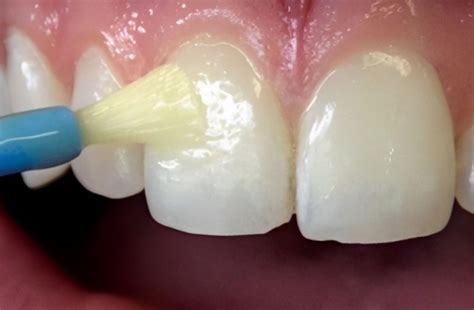 What To Avoid After Fluoride Varnish At James Cosner Blog