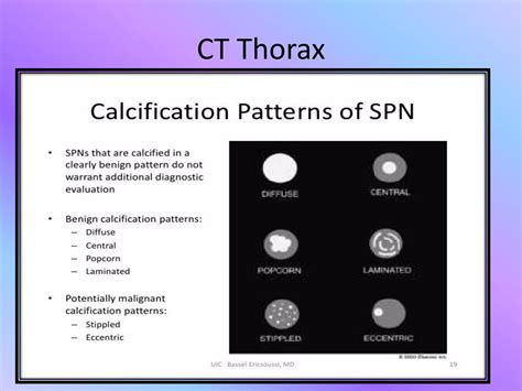 Approach To Solitary Pulmonary Nodule Pptx Lung And Respiratory Health Diseases And Conditions