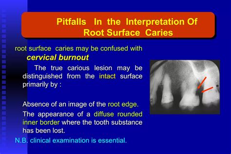 Radiographic Assessment Of Dental Caries Ppt