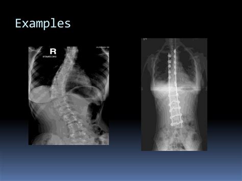 Ppt Spinal Deformities Powerpoint Presentation Free Download Id 632873