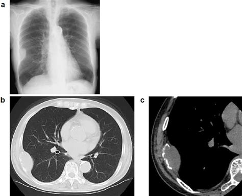 Figure1a A Chest Radiograph Showed A Tumor Shadow In The Right