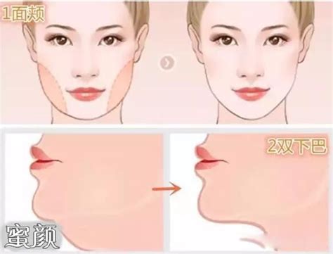 实现瘦脸梦想脸部抽脂术的效果与注意事项 蜜颜优惠